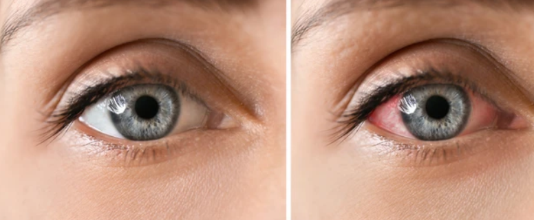 Blefarita : Ce este, cauze, simptome, tratament si precautii